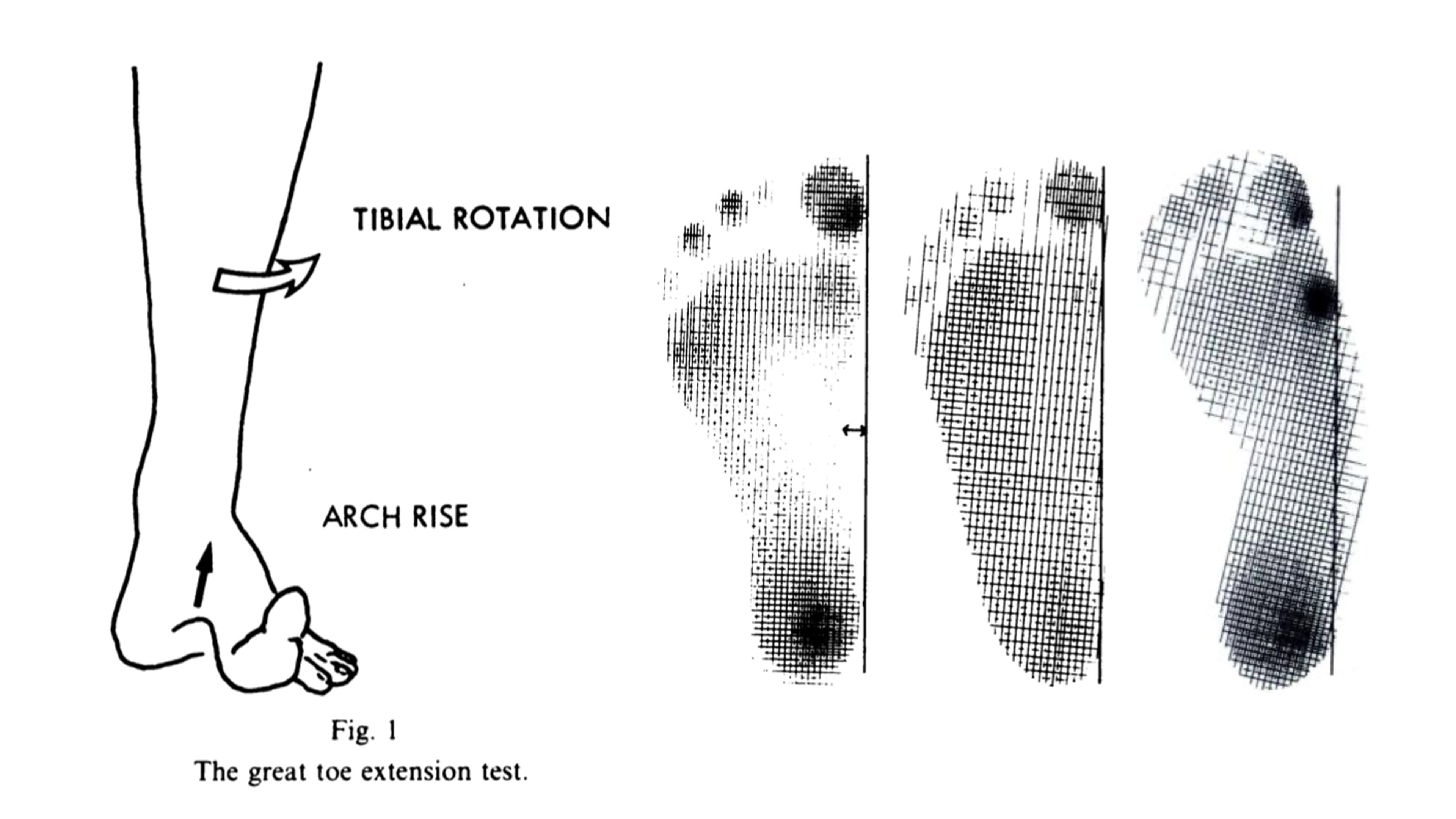 El diagnóstico de pie plano en niños. – My Foot Function