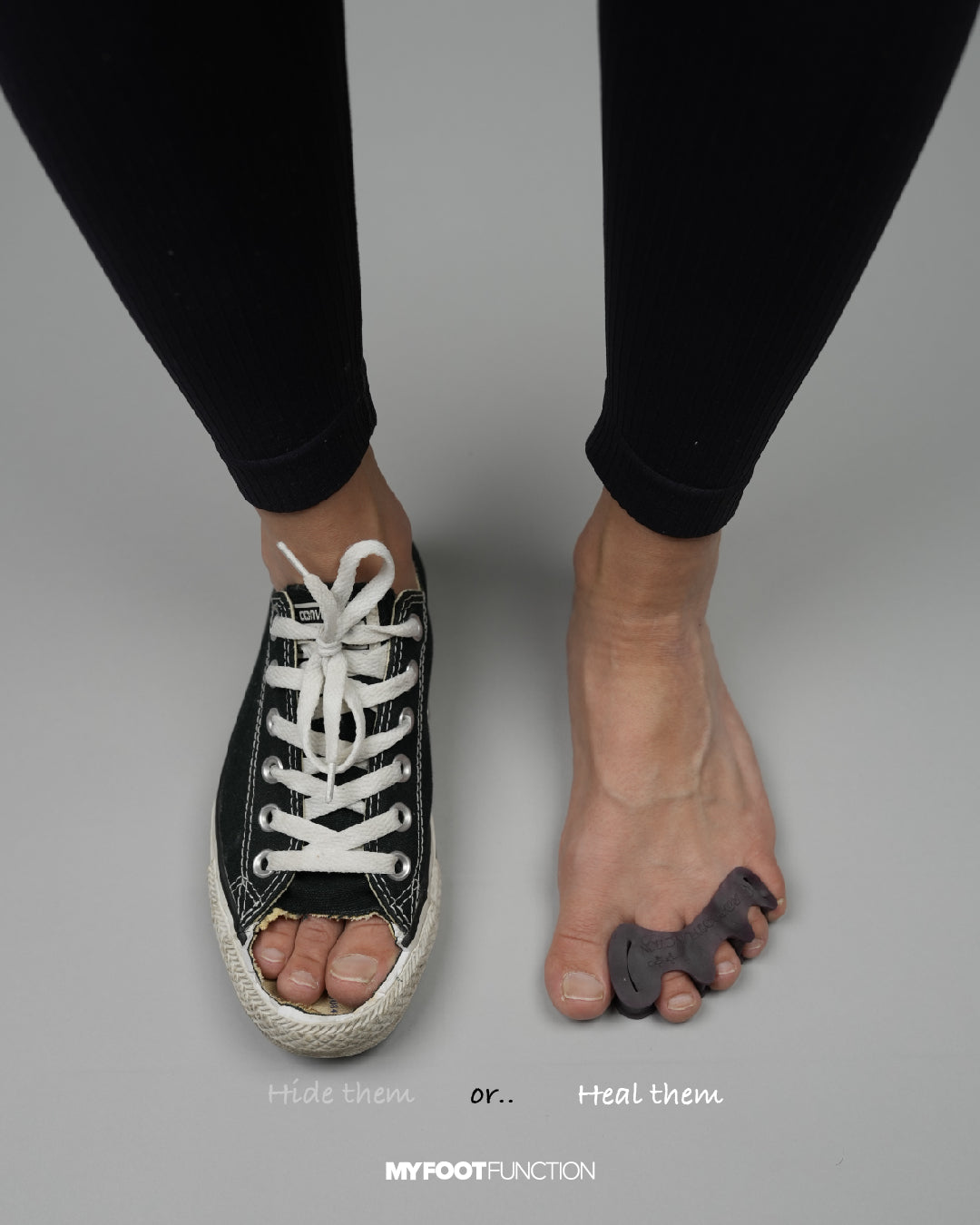 The Truth About Bunion Surgery: 64% Recurrence – My Foot Function