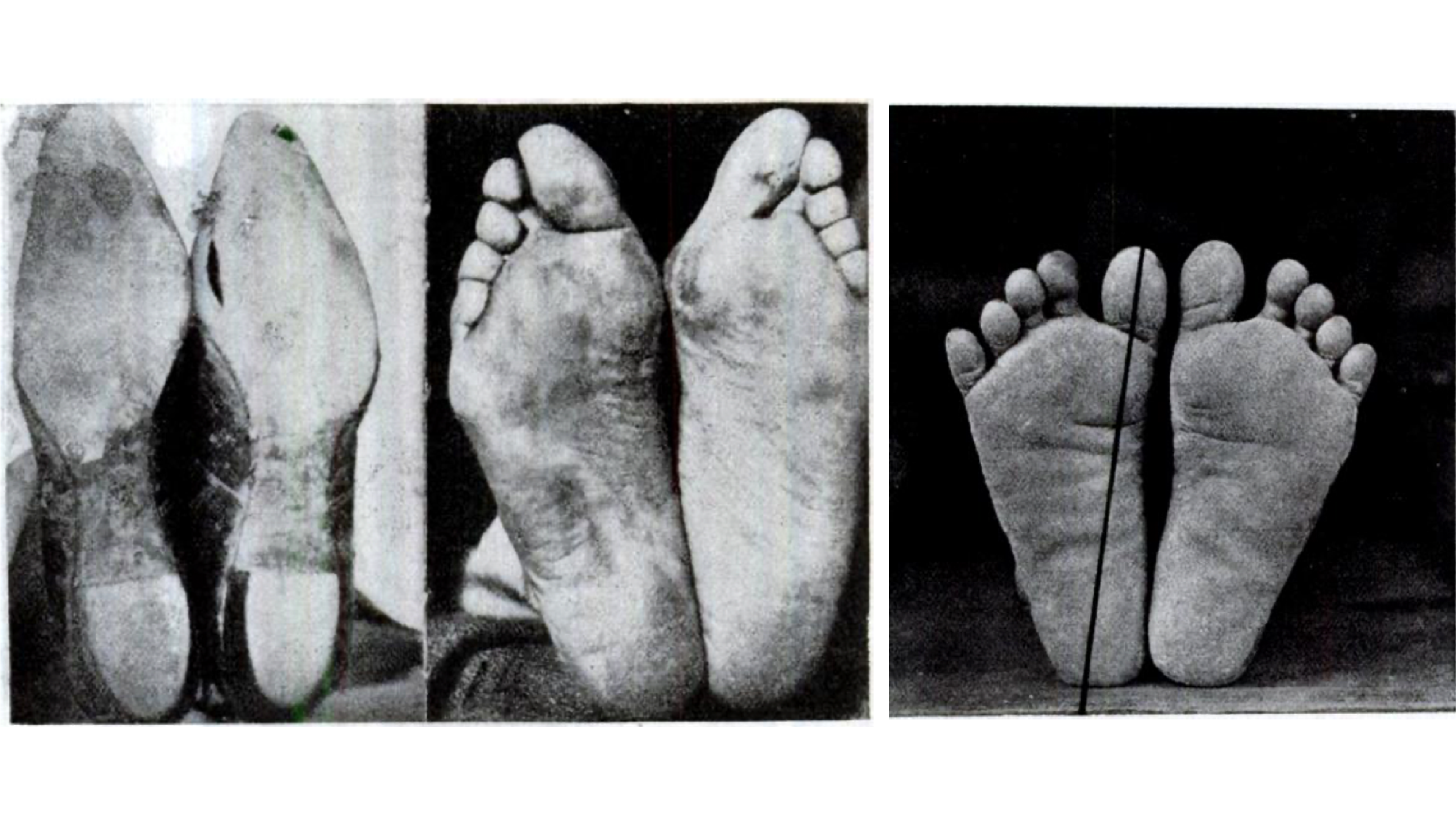 Comparison between shoe wearing population and barefoot – My Foot Function