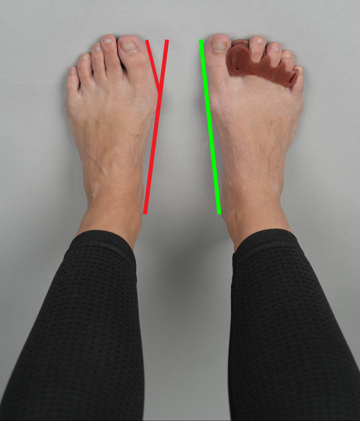 Subtalar Joint Axis Location and Rotational – My Foot Function